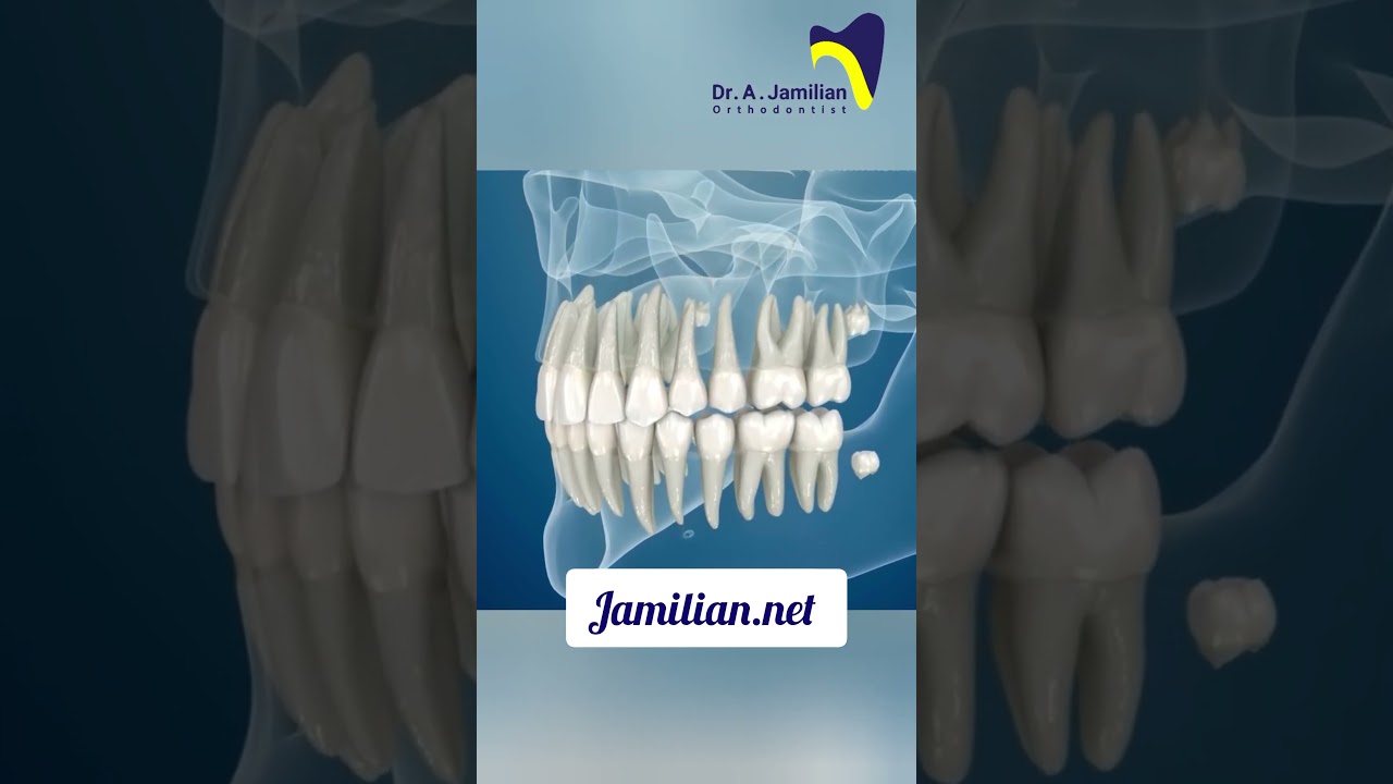 How do permanent teeth replace primary (baby) teeth? #dentist #teeth  #orthodontics #dentition