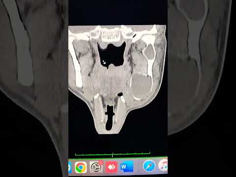 mandible lesion