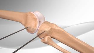 Patient Education in Orthopedic Surgery – OrthoIllustrated