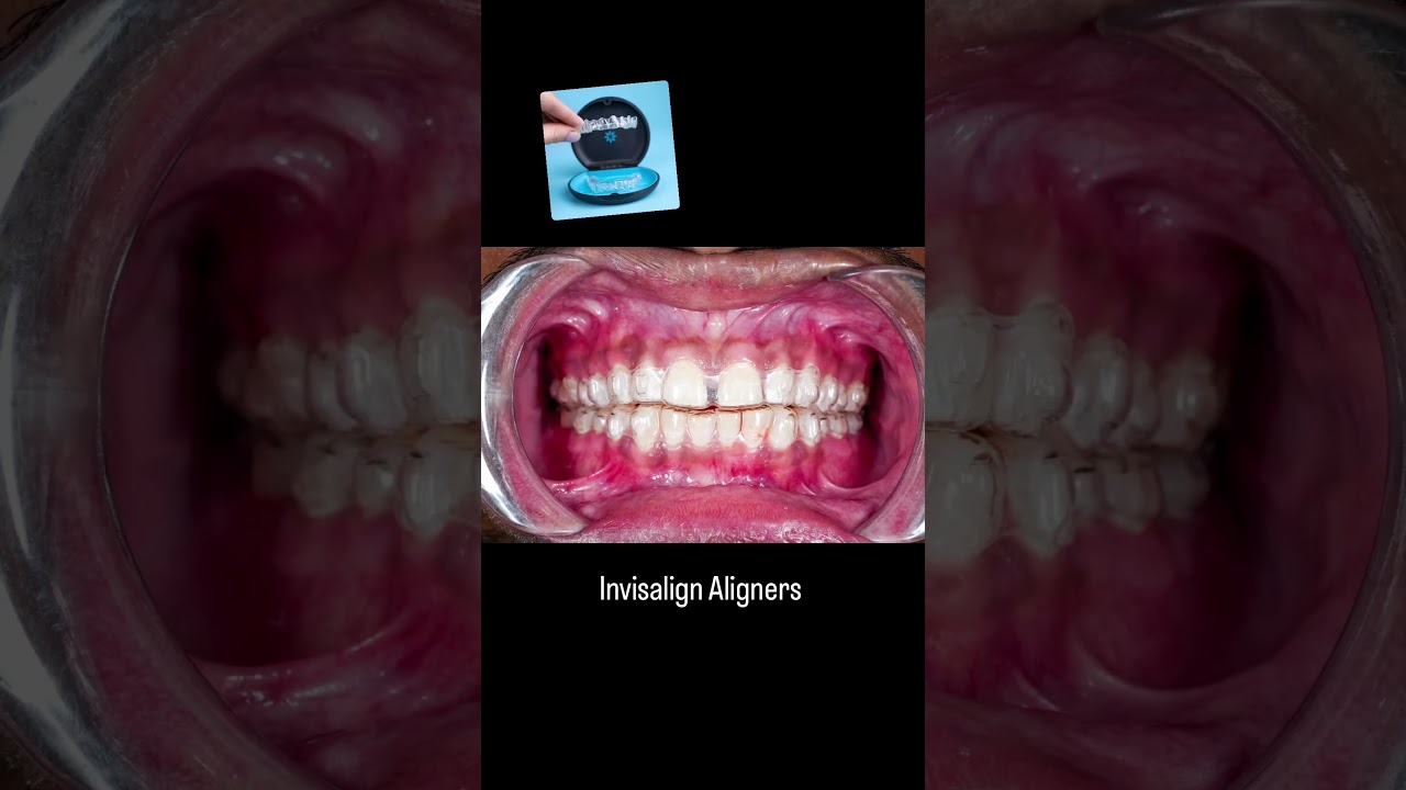 Midline diastema #invisalign