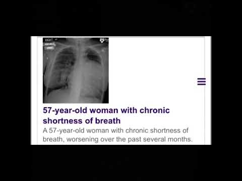 Eisenmenger syndrome