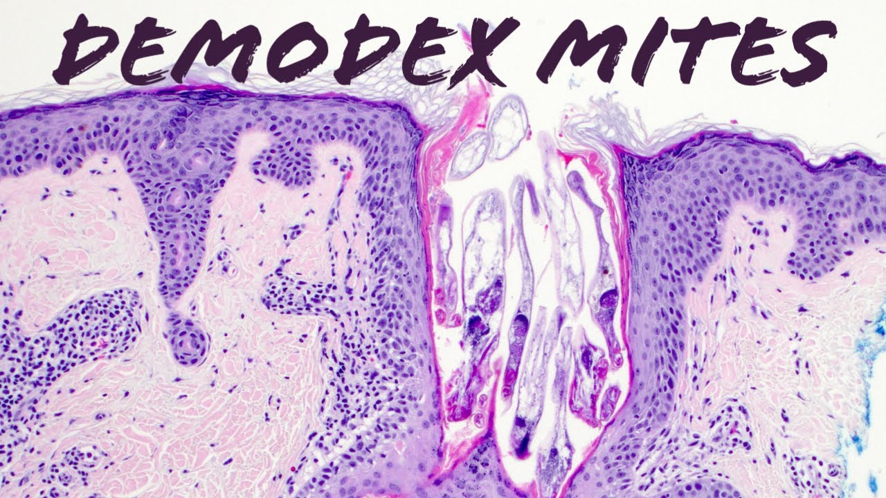 Demodex Mites under the microscope (Demodex folliculorum & Demodex brevis; demodex mites on face)