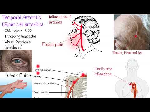 Temporal Arteritis (Giant Cell arteritis); Symptoms and treatment