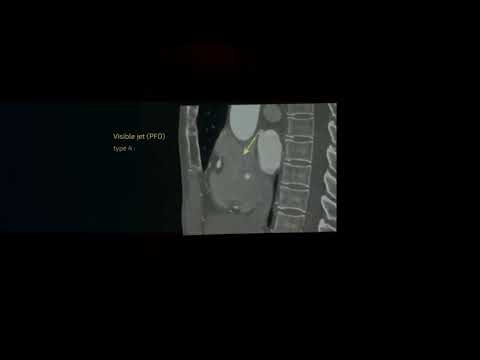 CT evaluation - type 4 inter atrial septum with patent foramen ovale
