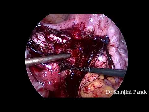 Tricky case of severe endometriosis and multiple myoma management.