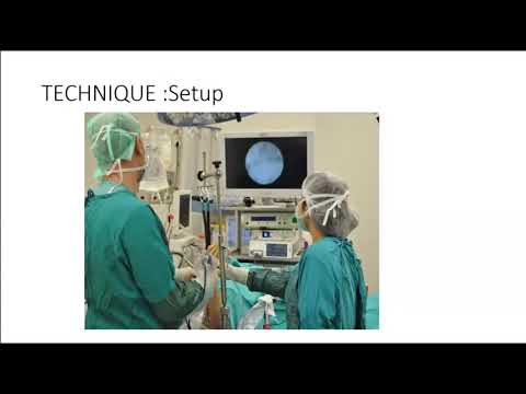 Carpal instability (Suture-button Fixation and Arthroscopic DorsalLigamento-capsulodesis)