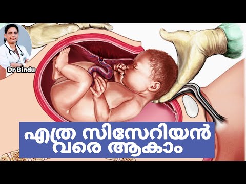 ഒരാൾക്ക് എത്ര സിസേറിയൻ വരെ ആകാം/How many safe cesarean section you can allow/Dr Bindu