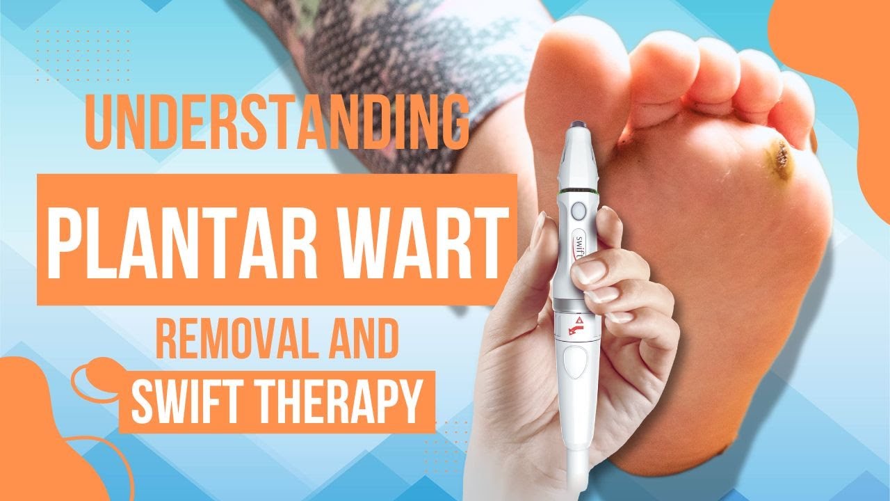 Understanding Plantar Wart Removal and Swift Therapy