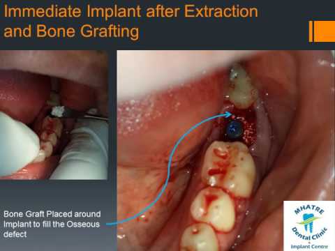 Immediate Implant after Extraction and Bone Grafting