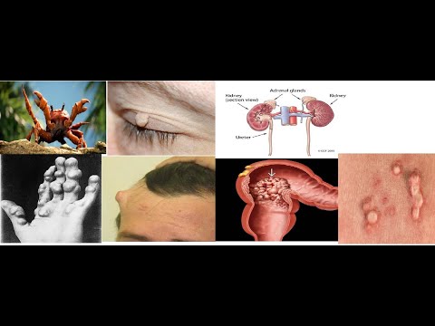 Definition of Neoplasm/Tumor and Benign Tumor; Part 1