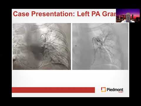 Catheter Intervention in Acute PE: It Saved my Patient_Klein_Peripheral On Demand