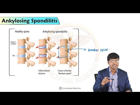 21. Ankylosing Spondylitis Simplified 🦴🔥 | High-Yield Internal Medicine for USMLE Step 2 CK