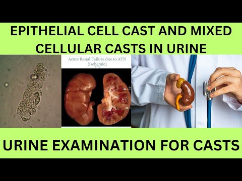 EPITHELIAL CELL CAST AND MIXED CELL CAST IN THE URINE .CAUSES SYMPTOMS AND TREATMENT