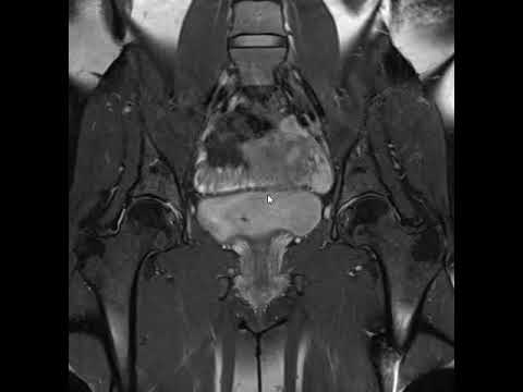Hip labral tear