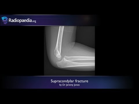 Supracondylar Fracture - Pediatric - Pediatrics - Orthobullets