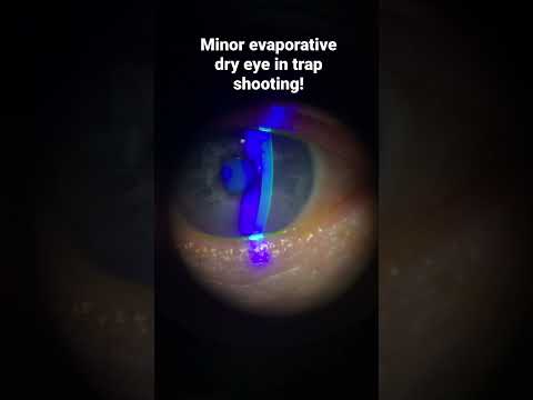 Tear film analysis for a #trapshooting client #shooting #shotgun #clayshooting #eyes