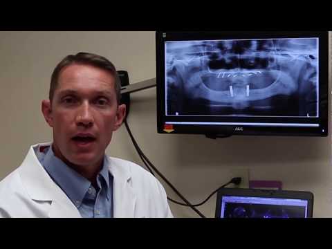 Post Op Dental Implant Care - Oral Surgery Associates of Colorado Springs