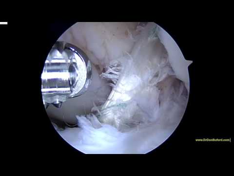 Left Knee Arthroscopy 11 28 2016 TM