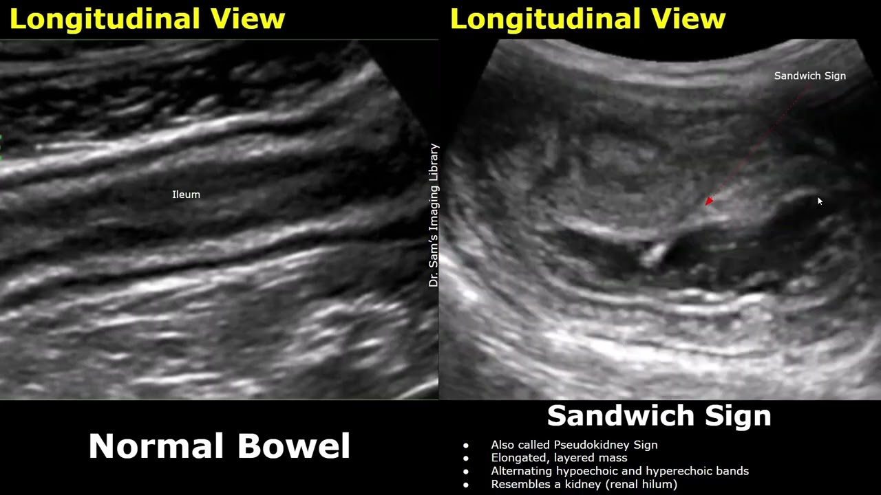 Abdominal Ultrasound Bowel Normal Vs Intussusception | Donut Sign, Sandwich Sign, Pseudokidney Sign