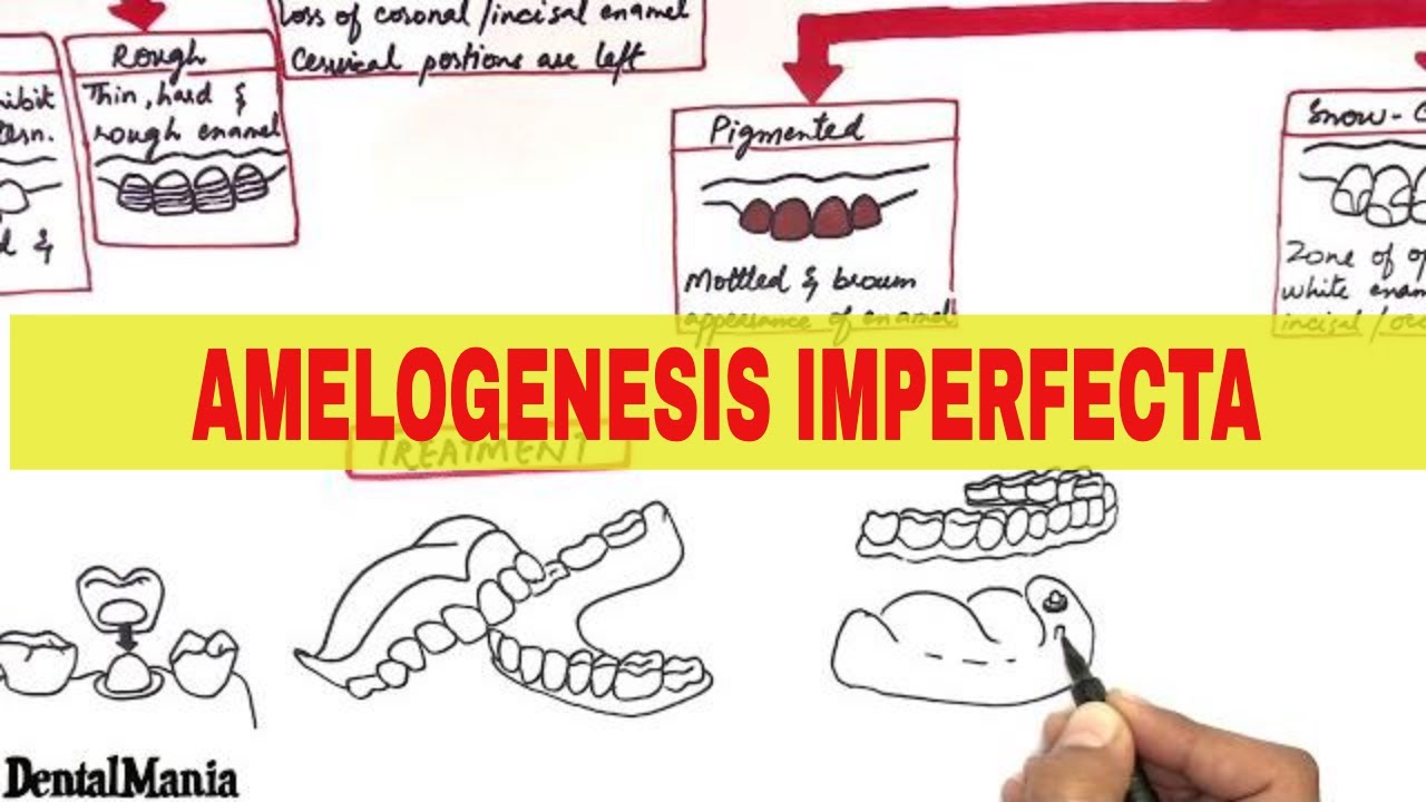 Amelogenesis Imperfecta - Pathogenesis, Types, Clinical features and Treatment