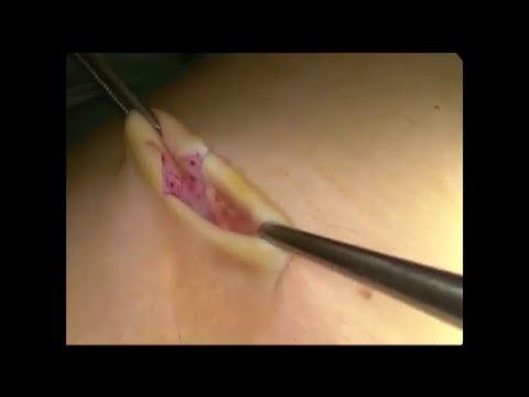 Single-port laparoscopic cholecystectomy made easy. Step 1: inserting the retractor.
