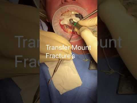Straumann Transfer Mount Fracture. Implant and Immediate Explant #transfermount #loxim #implant