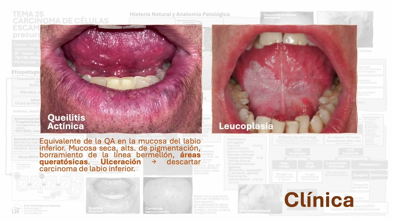 Topic 25. Squamous cell carcinoma and precursor lesions