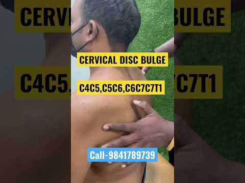 Cervical Discbulge -Chiropractic Treatment-DrVijay