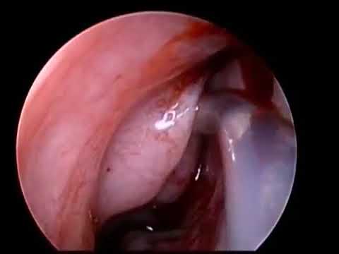 Maxillary Sinus Balloon Sinus Surgery - ENT Associates