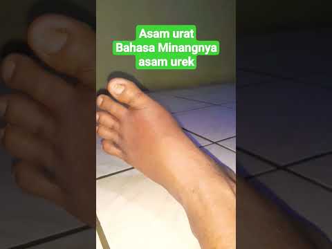 Penyakit asam urat, Bahasa Minangnya asam urek.