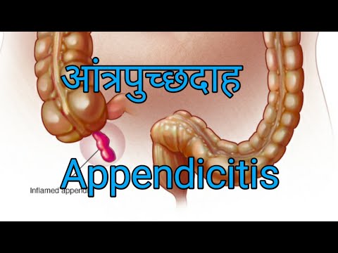 अपेन्डिस/आंत्रपुच्छदाह म्हणजे काय|अपेंडिक्स वर घरगुती उपाय|अपेंडिक्स ची लक्षणे|Appendicitis Home Rem