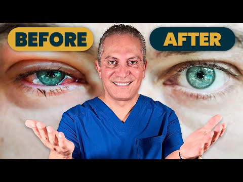 How to Get Rid of Blepharitis in 2024? | Top 2 Treatments by Eye Doctor