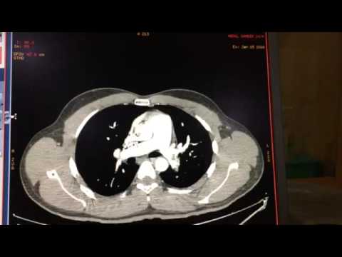 CT scan thorax of pulmonary embolism