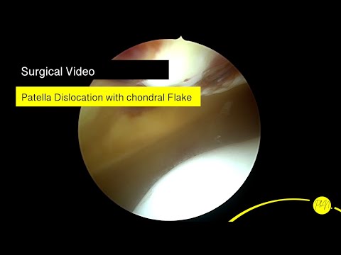 Acute Dislocation with chondral Flake treated with MPFL and Minced Cartilage
