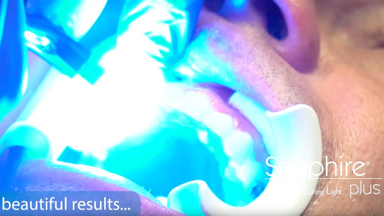 Sapphire® Plus - 30-Second Dentistry™ - Patient: Randy