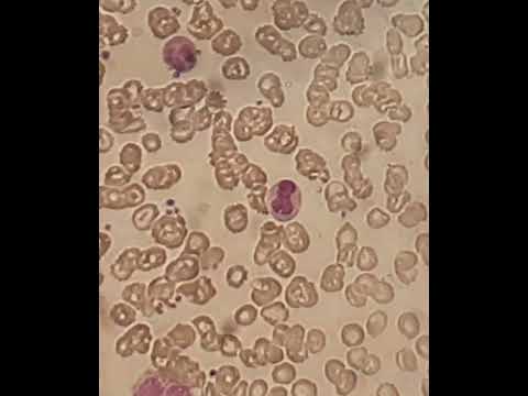 left shift of Neutrophil (immature Neutrophil) in blood smear.