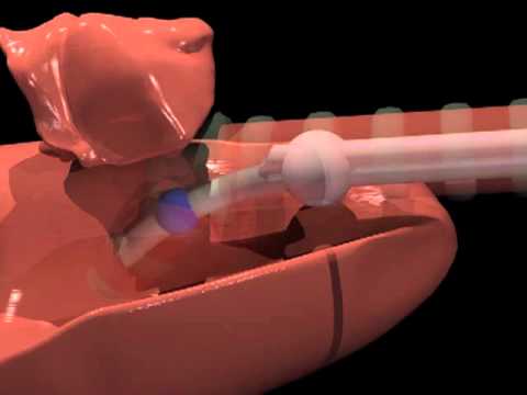 VATS animation