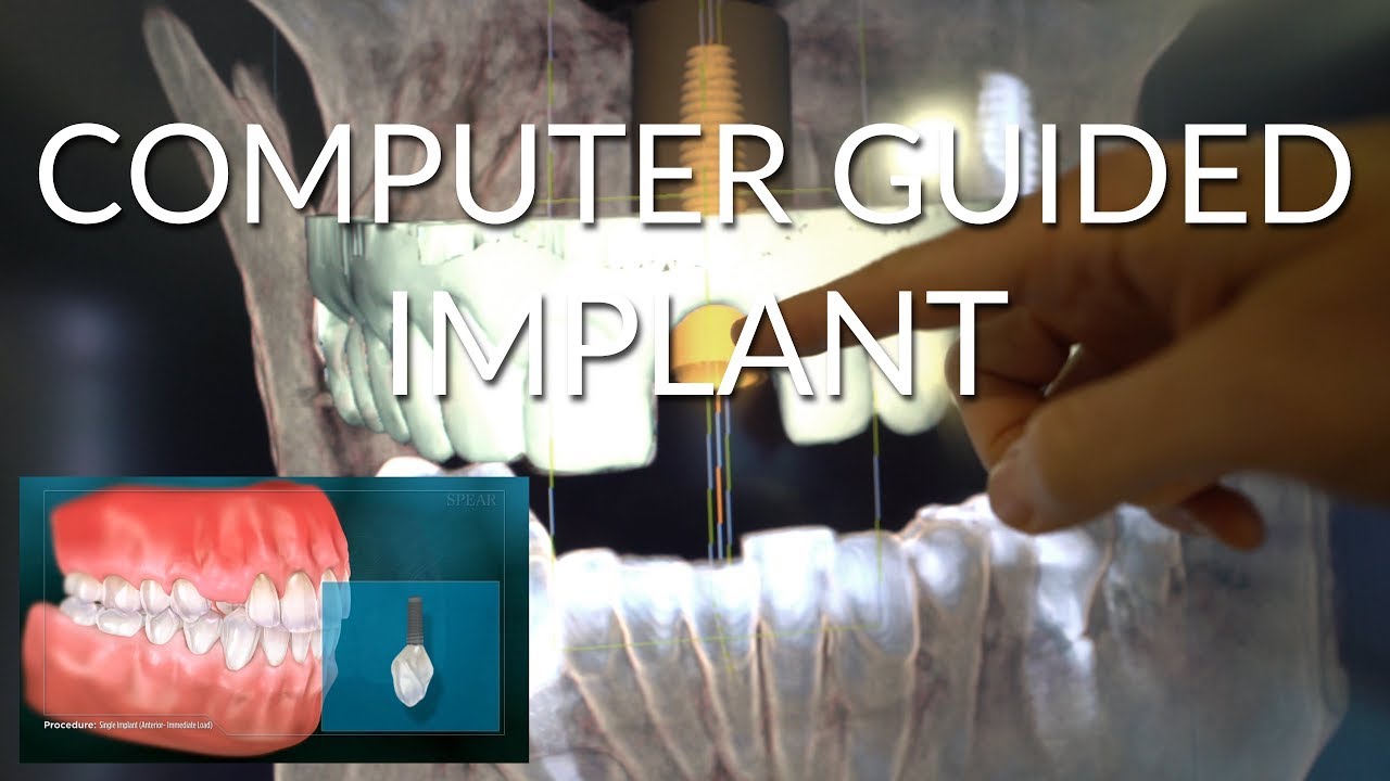 Computer Guided Dental Implant - Crisis Averted