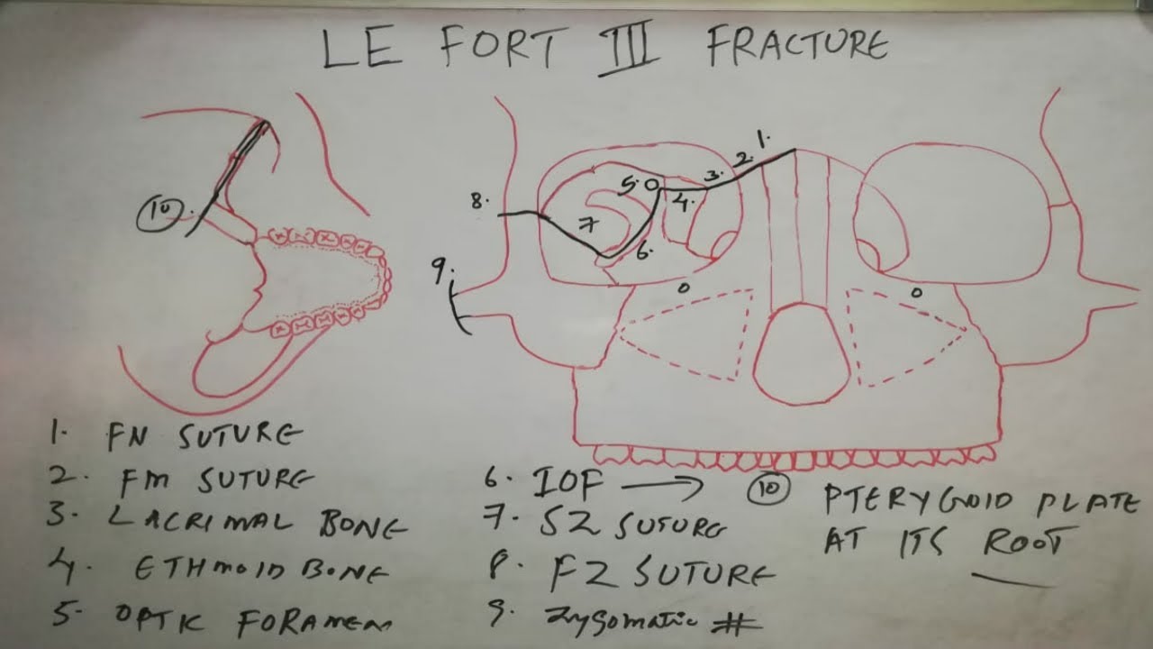 Le fort III fracture line