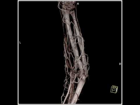 MDCT 64: CTA upper extremity: Occluded shunt in forearm with detailed vascular mapping. (4 of 5)