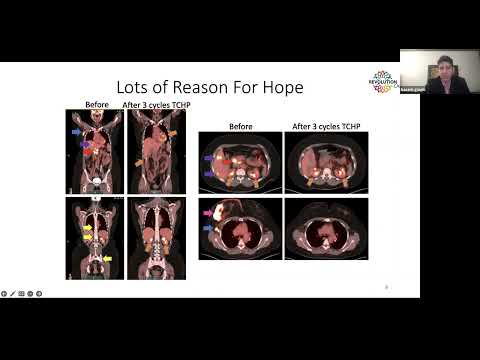 Stage 4 Breast Cancer - Part 3/4 - "Treatment of stage 4, HER2 positive breast cancers"