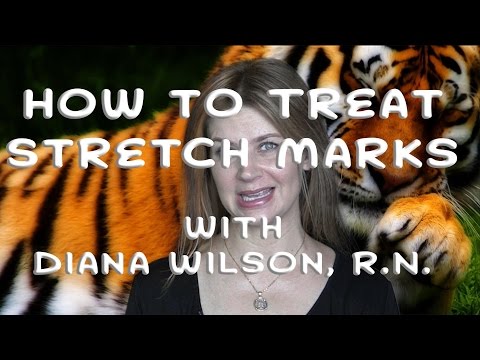 Stretch Marks, Causes & Medical Treatment Options