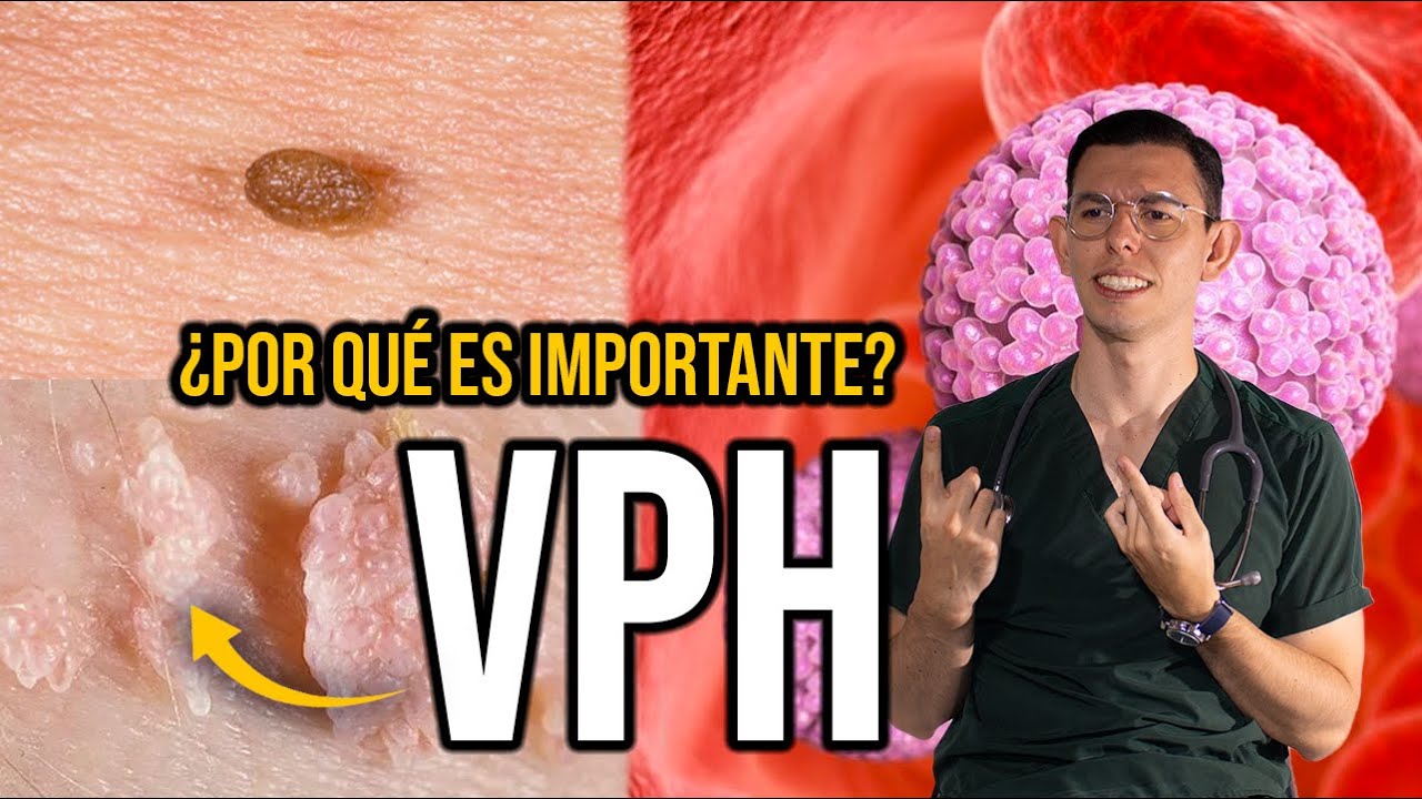 Virus del Papiloma Humano ¿Por qué es IMPORTANTE? |DrPoloGuerrero