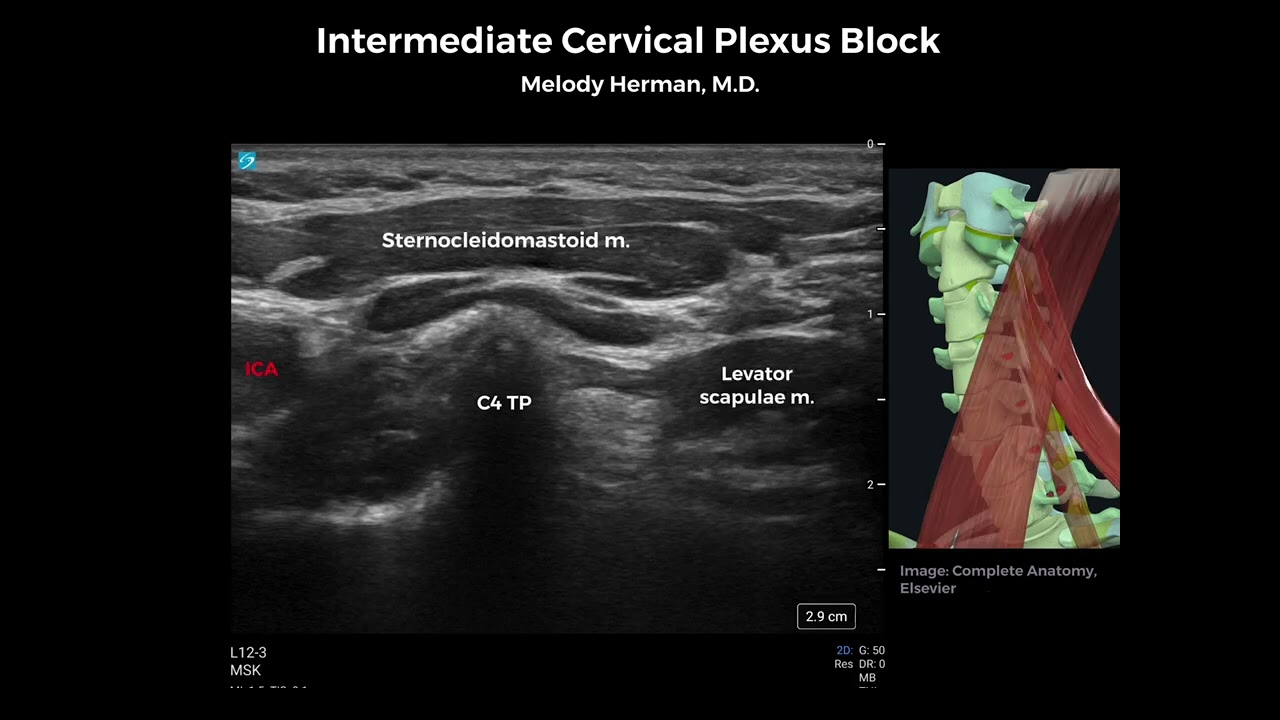 Intermediate Cervical Plexus Block