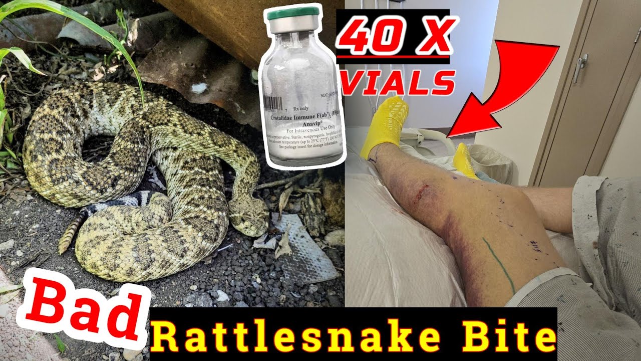 Rattlesnake Bite While Herping Central Texas