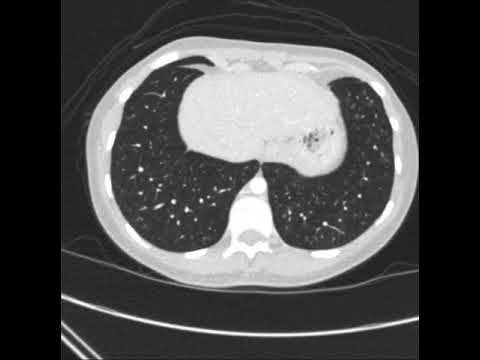 Pulmonary AVM Unannotated