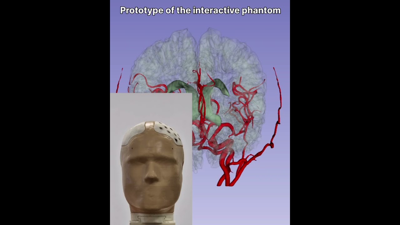 Training in stereotactic neurosurgery (stereoEEG) #stereotactic #epilepsy #SEEG