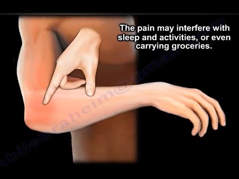 Tennis elbow, what is Tennis elbow and why it hurts ? Tennis elbow symptoms, causes and treatment.