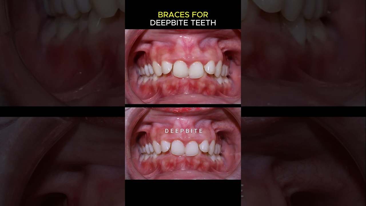 Why you should fix deep bite teeth #braces #orthodontist #dentist