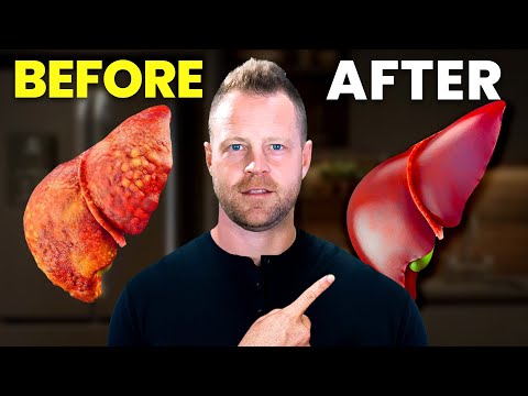 How to Fix Your Fatty Liver at Home...5 Tips